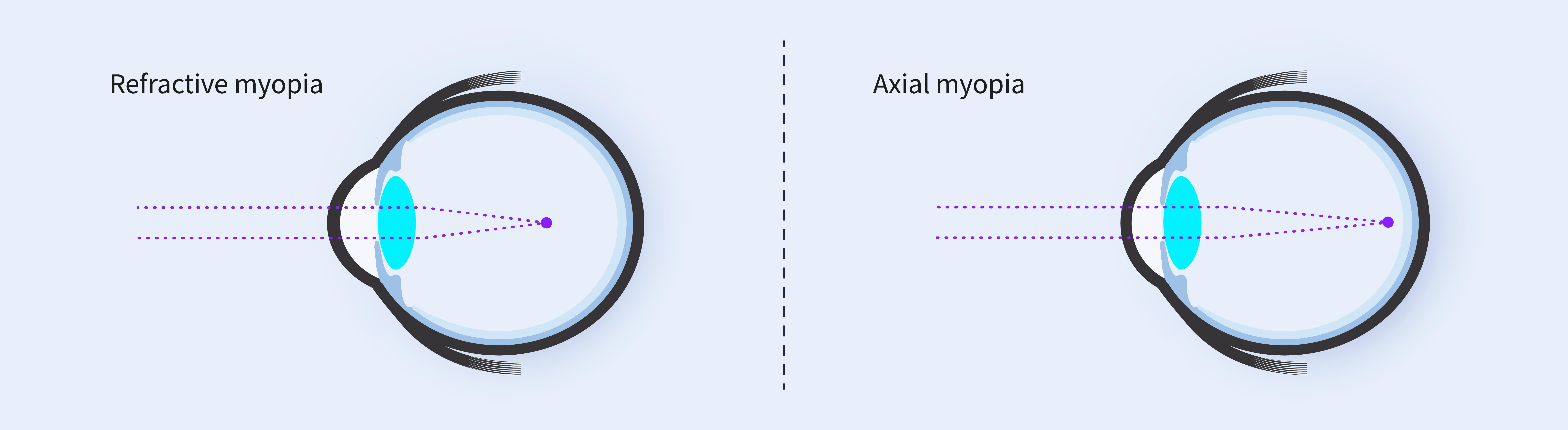 What is Myopia and Can Glasses Correct It?