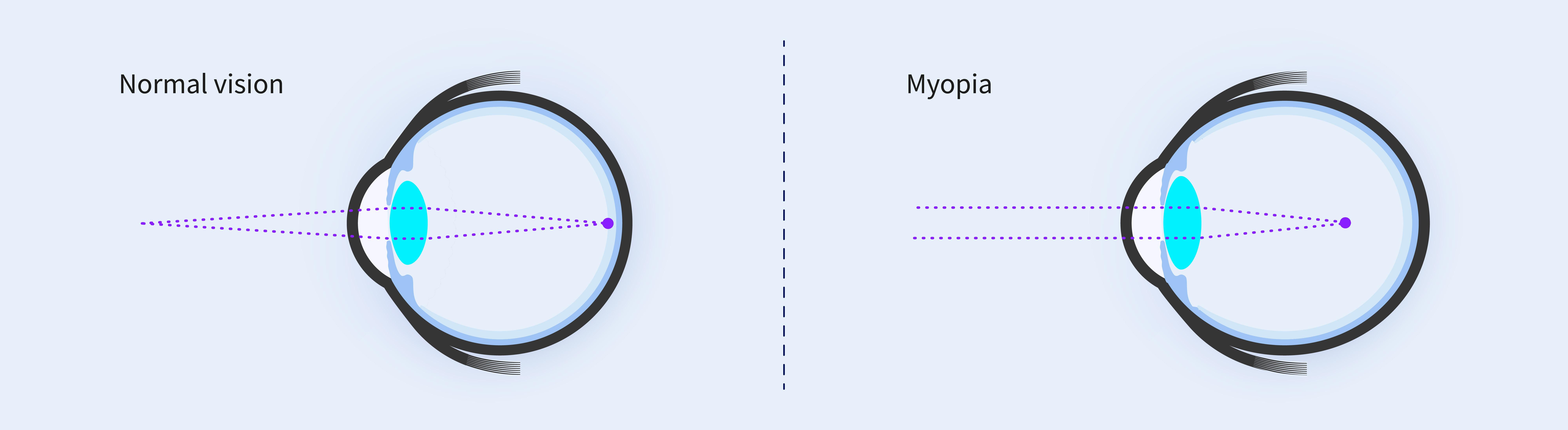 What is Myopia and Can Glasses Correct It?