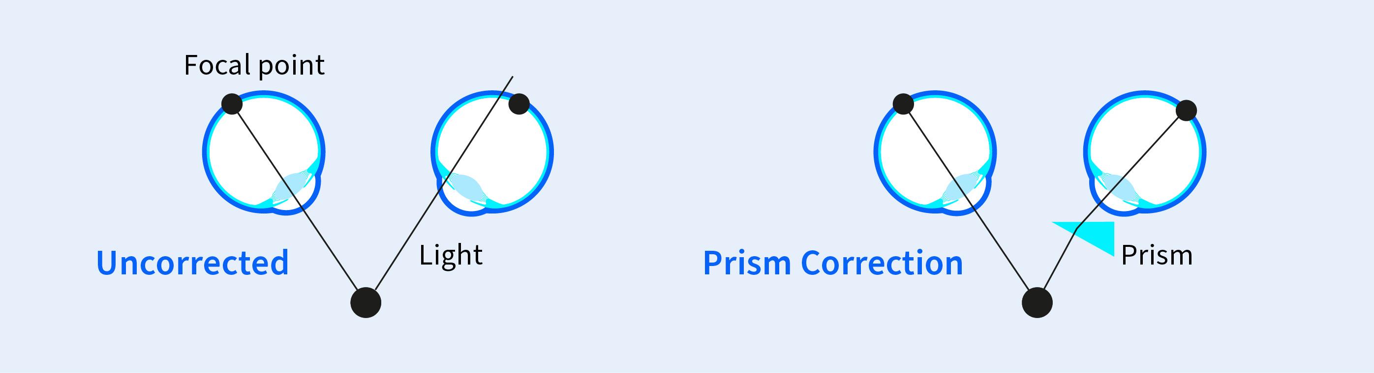 Detecting Binocular Vision Issues and Managing Them with Prism Correction
