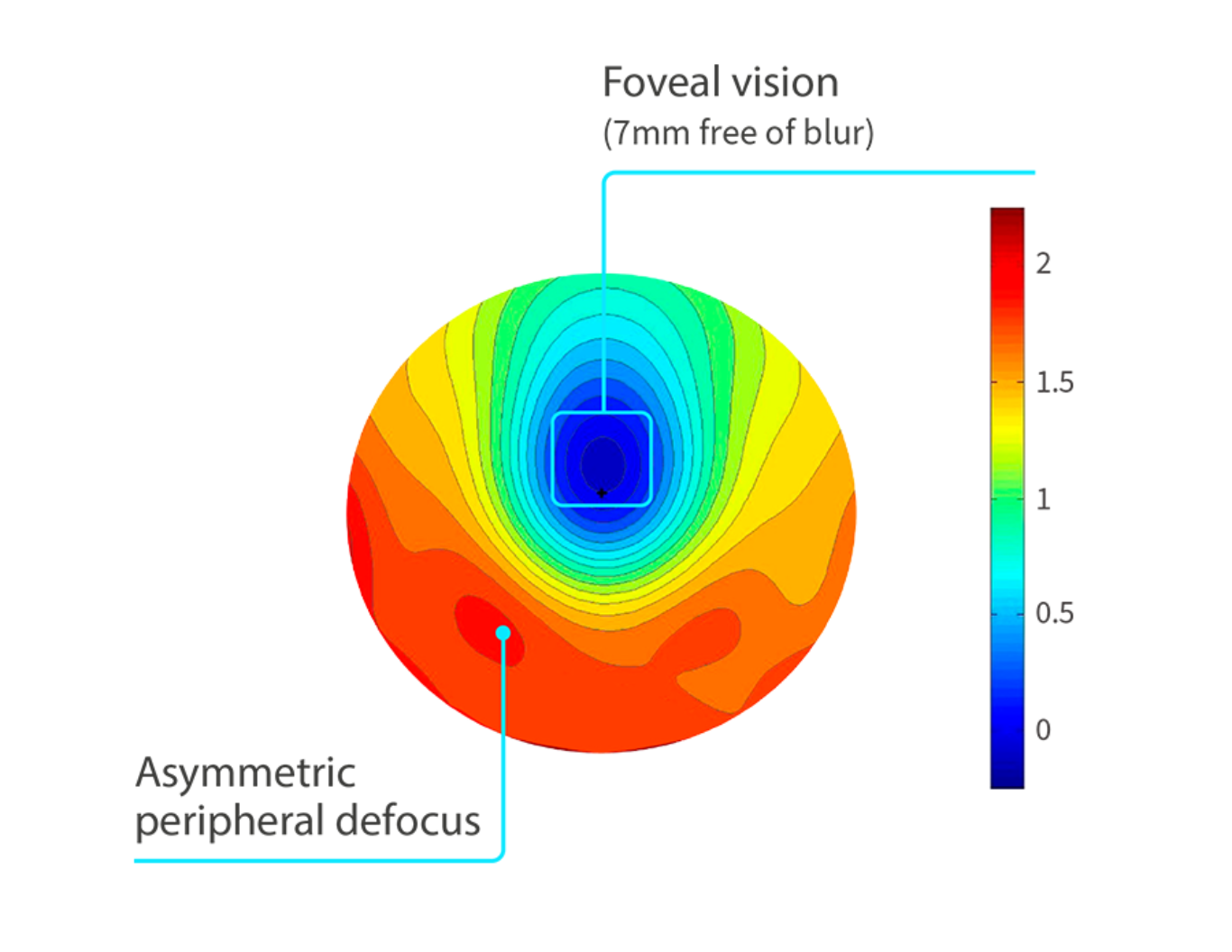 Myopia Management Lenses | IOT